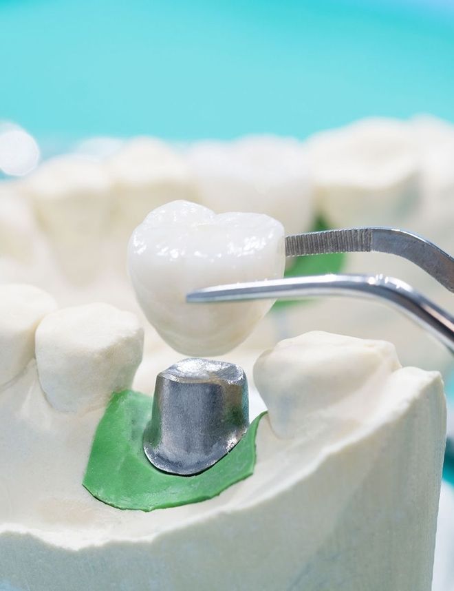 Zahnkronen in Graz anfertigen lassen bei Zahnärztin MDDr. Nathalie Neustadt